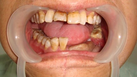 Bệnh Angine de Ludwig: Nguyên nhân, biến chứng và cách điều trị