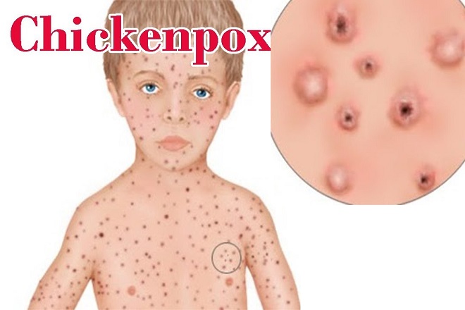 Bệnh Chicken-pox: Nguyên nhân, biến chứng và cách điều trị
