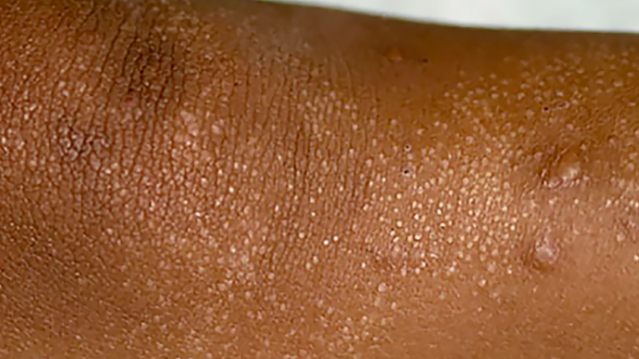 Bệnh Lichen nitidus: Nguyên nhân, biến chứng và cách điều trị